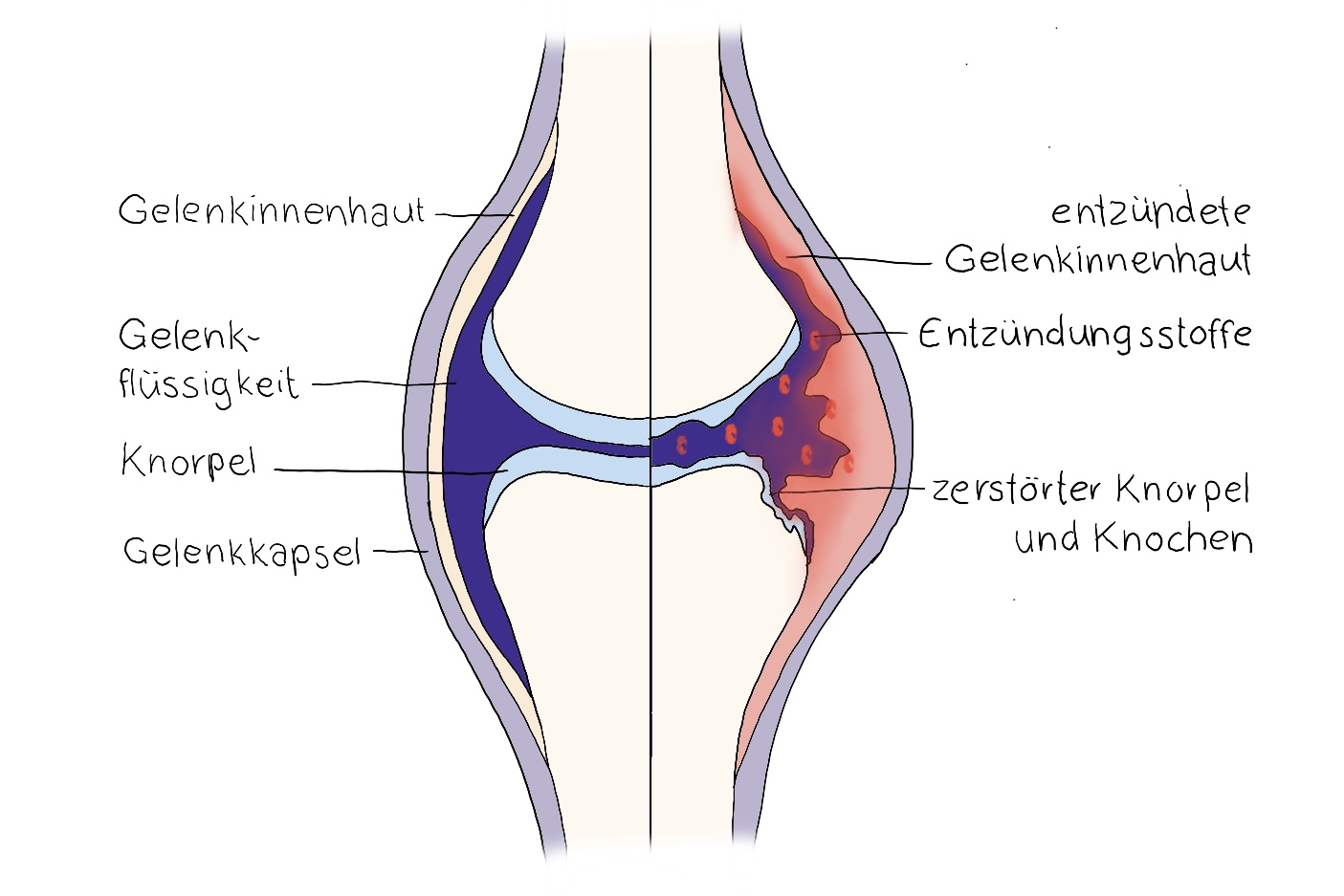 Rheumatische Arthritis – Physiotherapie & Osteopathie Beger | Leipzig Böhlitz-Ehrenberg